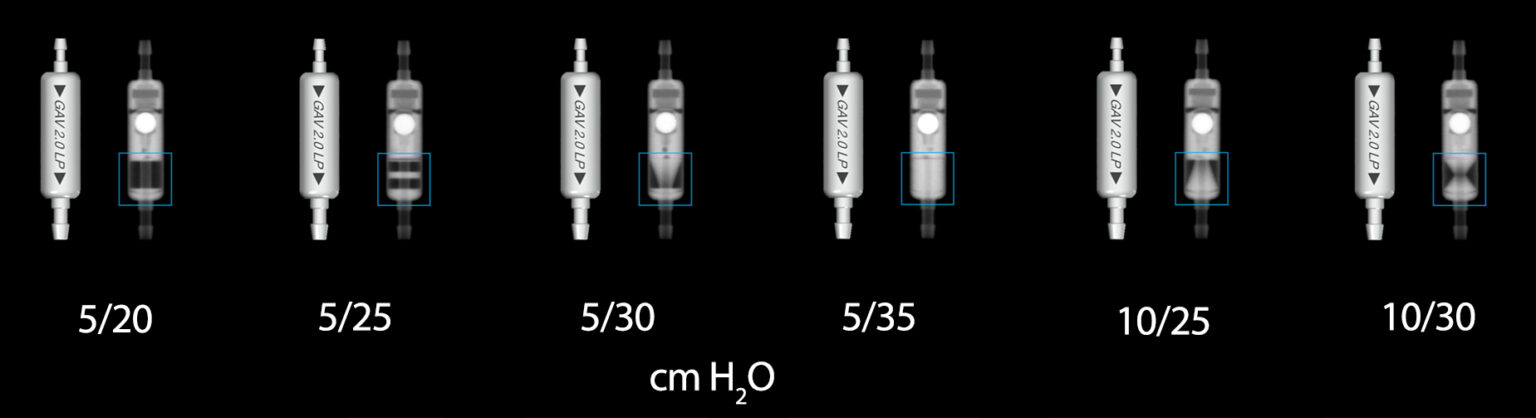 Radiologische Identifikation von Shuntventilen und Shunteinstellungen ...