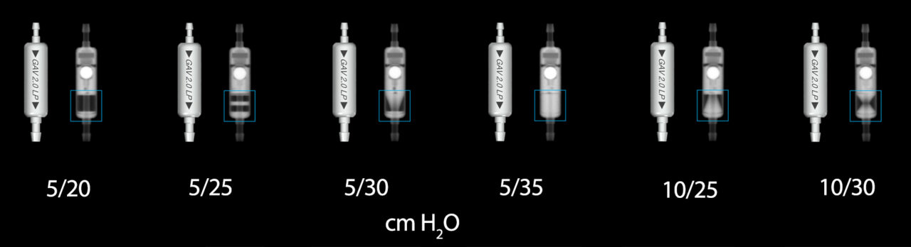 Radiologische Identifikation von Shuntventilen und Shunteinstellungen ...