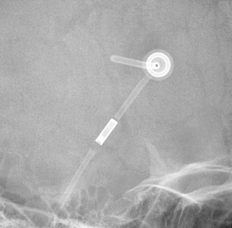 Radiologische Identifikation von Shuntventilen und Shunteinstellungen ...